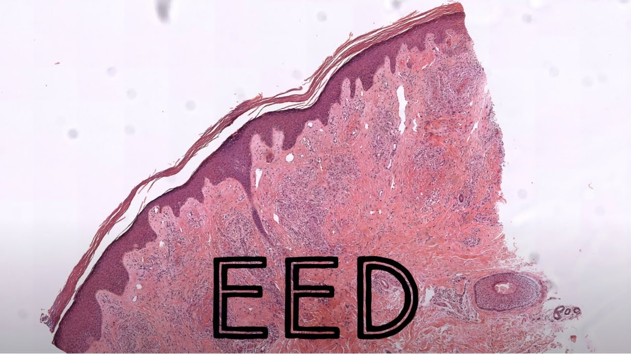 EED (Erythema elevatum diutinum) fibrosing vasculitis (dermpath ...