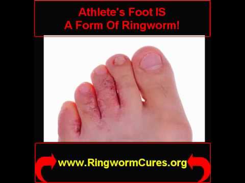 Ringworm Pics - How To Know If You Are Infected! - YouTube