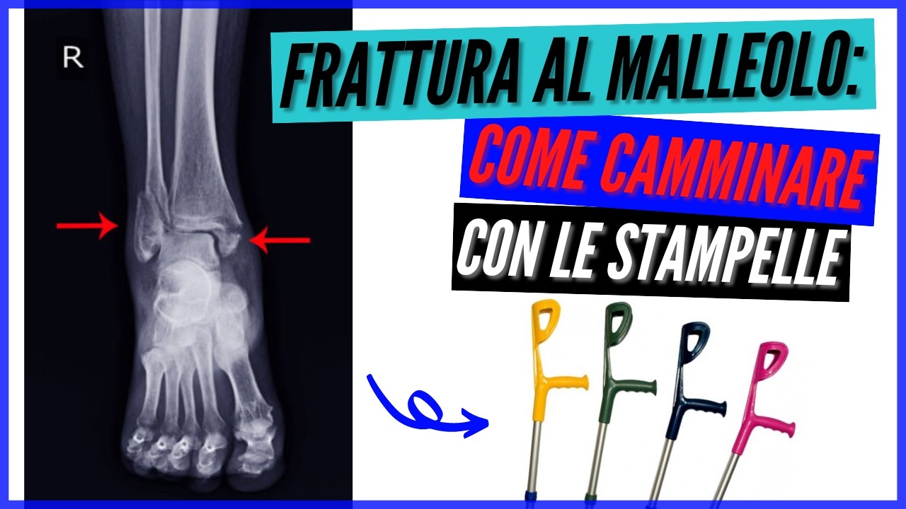 Frattura al malleolo come camminare con le stampelle - YouTube