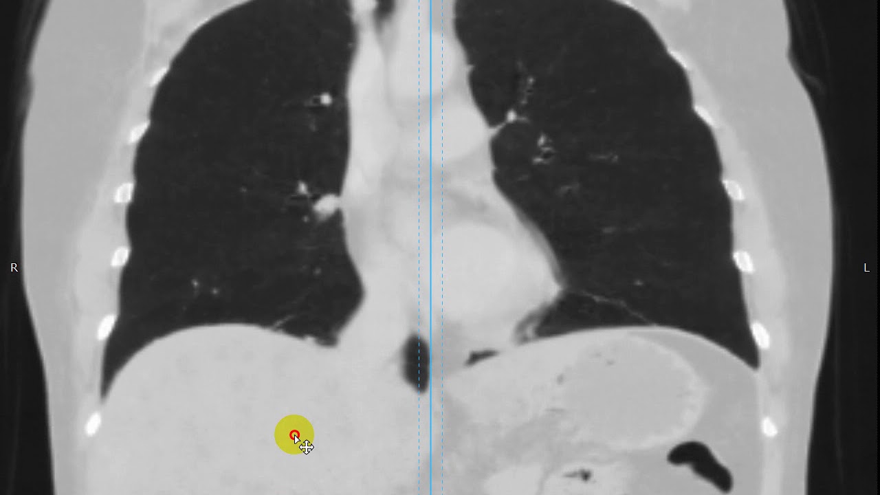 MinIP Minimum Intensity Projection in Interstitial Lung Disease Ground ...