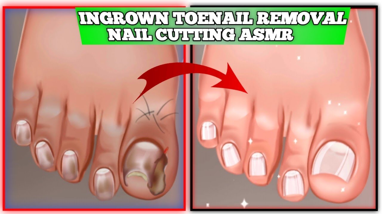ASMR Nail Cutting Coolness | Ingrown Toenail removal treatment ...
