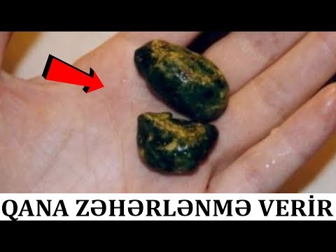 Öd daşı Hamilələrdə uşağı öldürə bilər!
