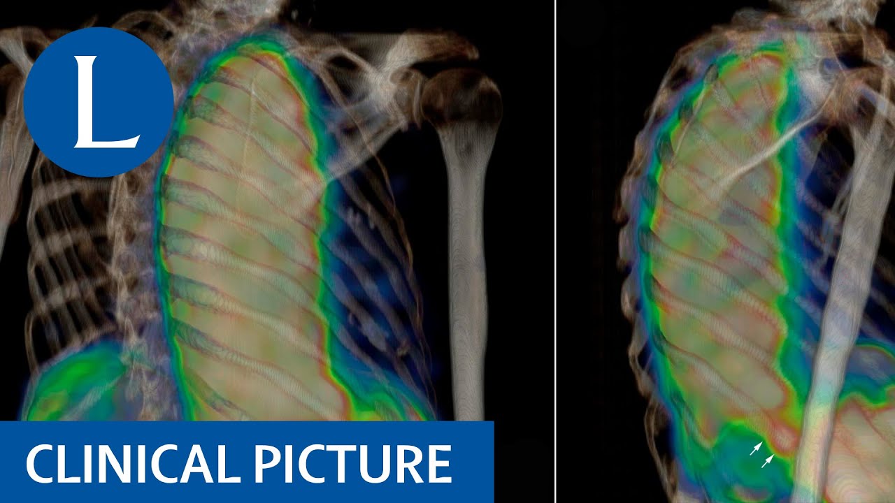 Pleuro-peritoneal communication in a patient on dialysis - YouTube