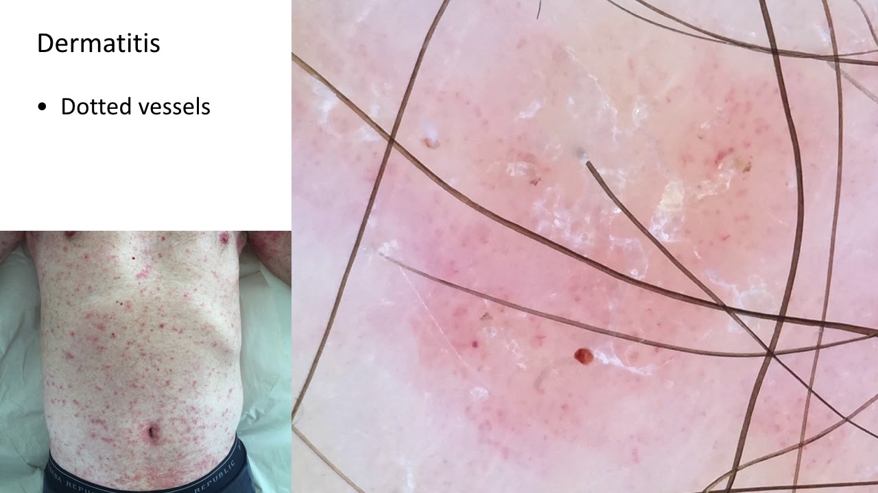 Dotted Vessels - Dr. John Paoli - YouTube