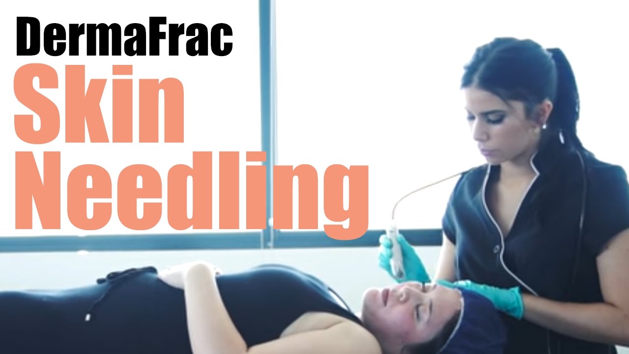 Dermafrac skin needling and infusion system - YouTube