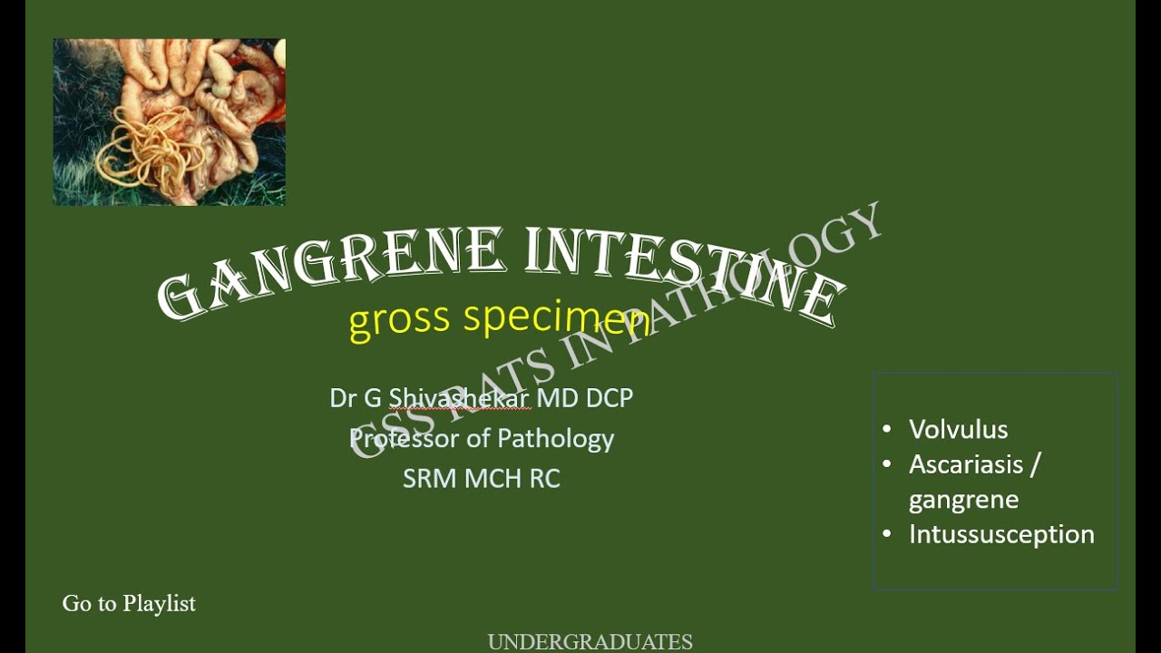UG Spotter GANGRENE INTESTINE/ Ascariasis - Gross description/ Viva ...