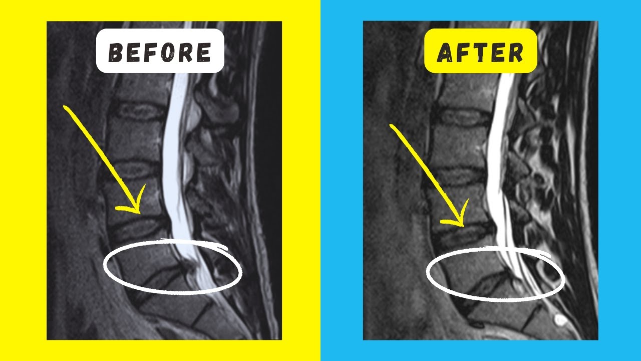 Lumbar Disc herniation L5 S1 Reabsorption in 7 months - YouTube