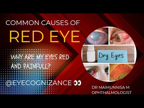 why are my eyes red and painfull? |causes of Red Eyes |eyecognizance ...