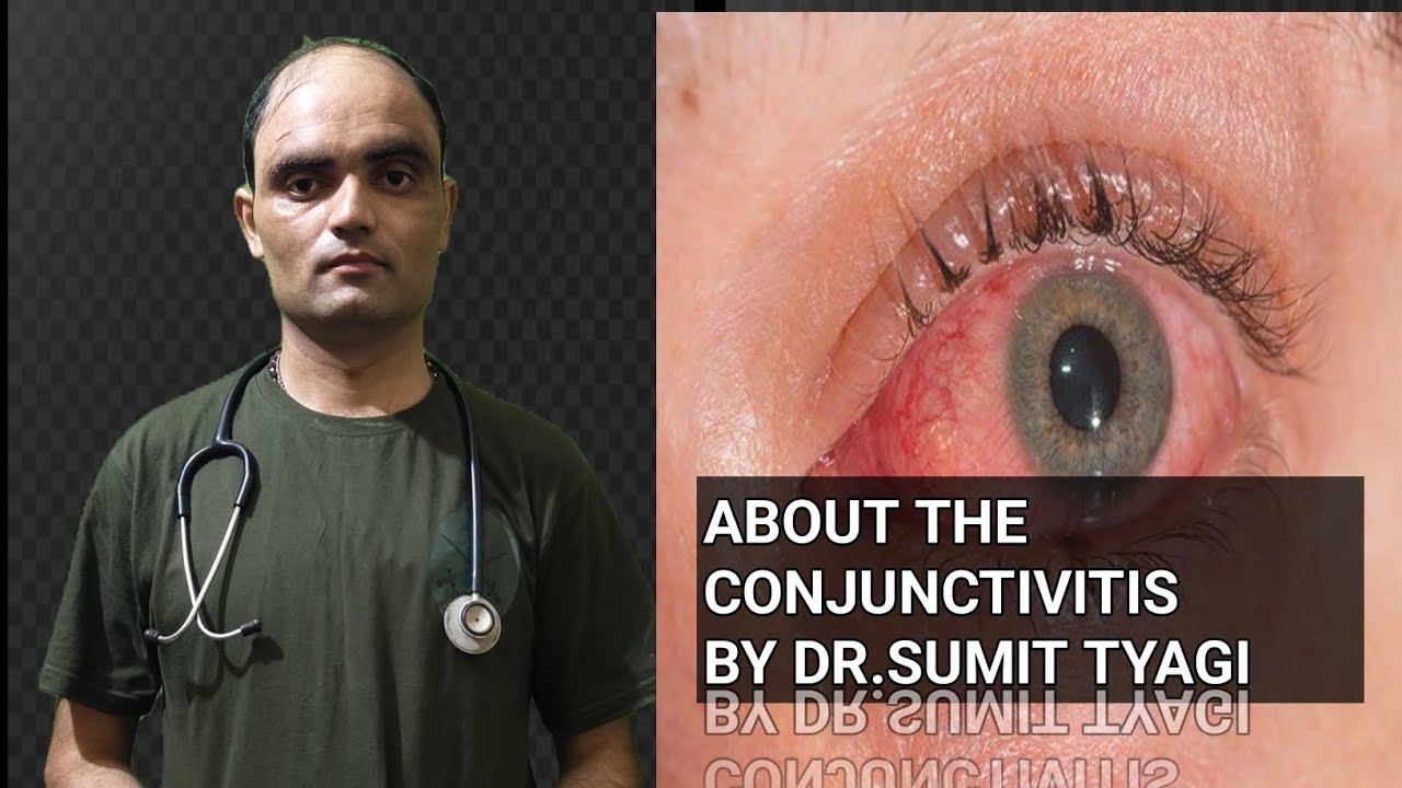 ABOUT THE CONJUNCTIVITIS BY DR.SUMIT TYAGI@SUMITMEDICALDISPENSARY1 ...