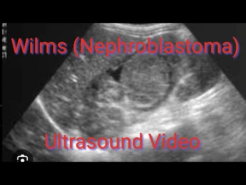 NEPHROBLASTOMA. Wilms Tumor ultrasound appearence on video ...