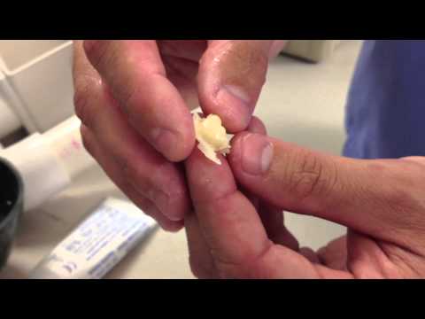 How to Fabricate Acrylic Temp- - YouTube