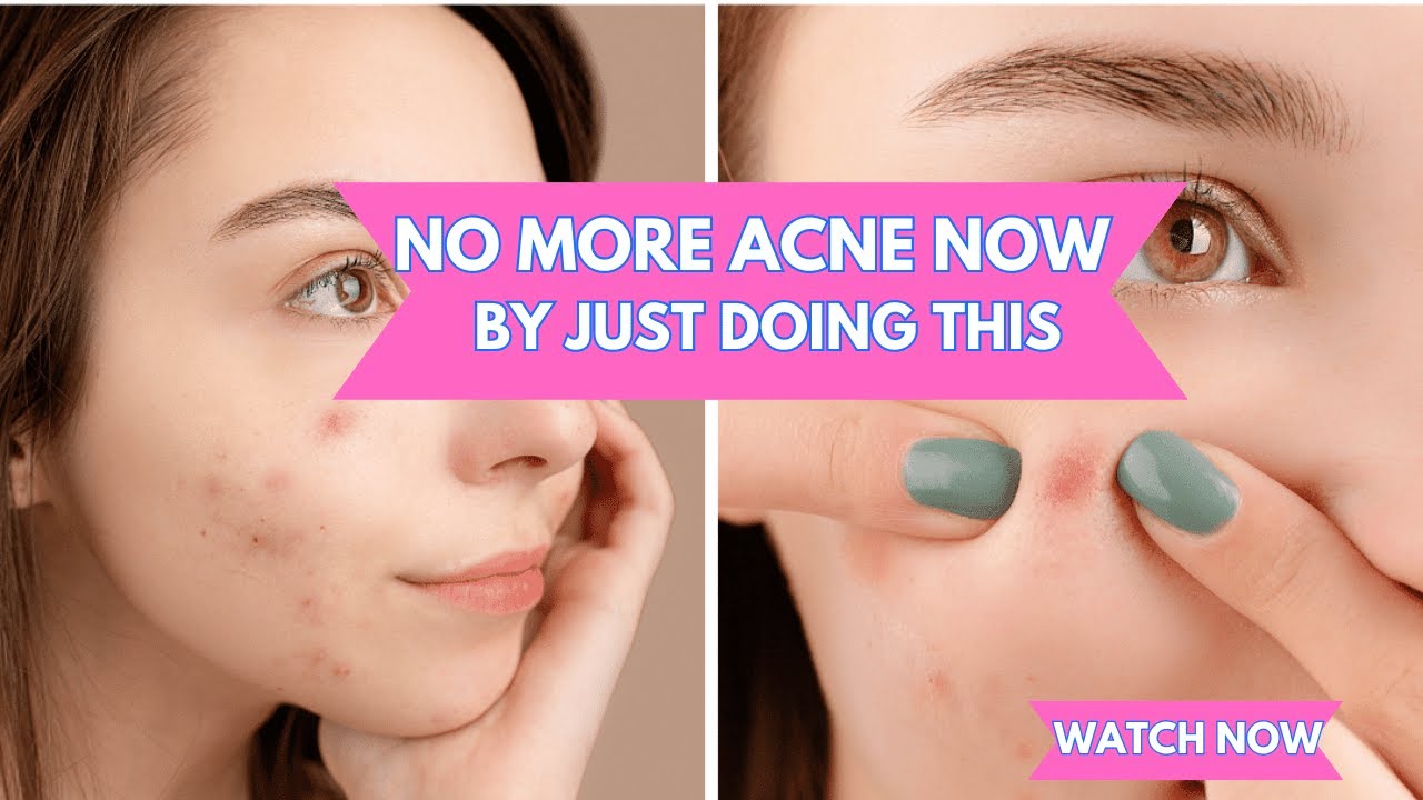 No More Acne Now || Best Skincare routine for acne prone skin - YouTube