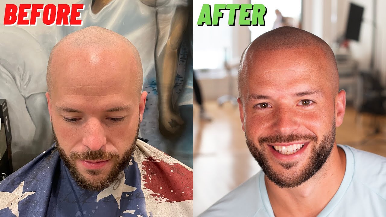 SUPER NATURAL Scalp Micropigmentation Transformation in New York City ...