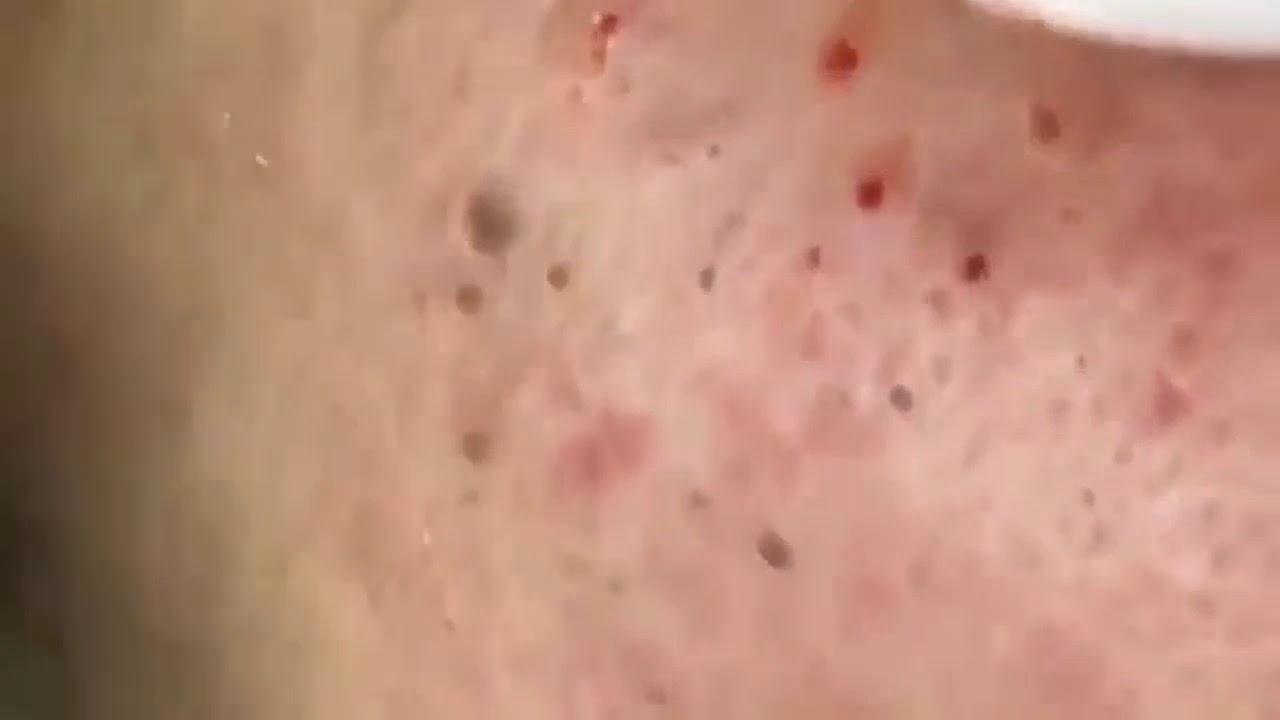 Pimple Popping Removing Blackheads On The Face Acne 159 Youtube
