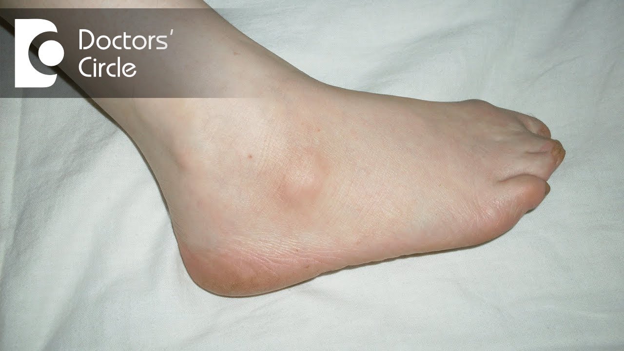 When does one need to undergo surgery for Multiple Lipomas? - Dr ...