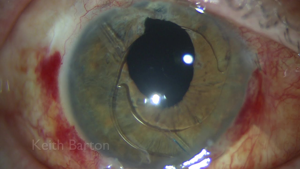 PDR, Trauma, AC IOL and secondary glaucoma, controlled with Baerveldt ...