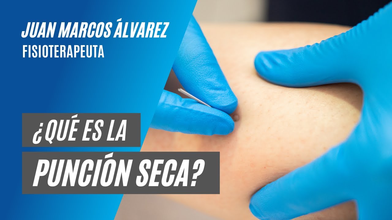 ¿Qué es la punción seca? - YouTube
