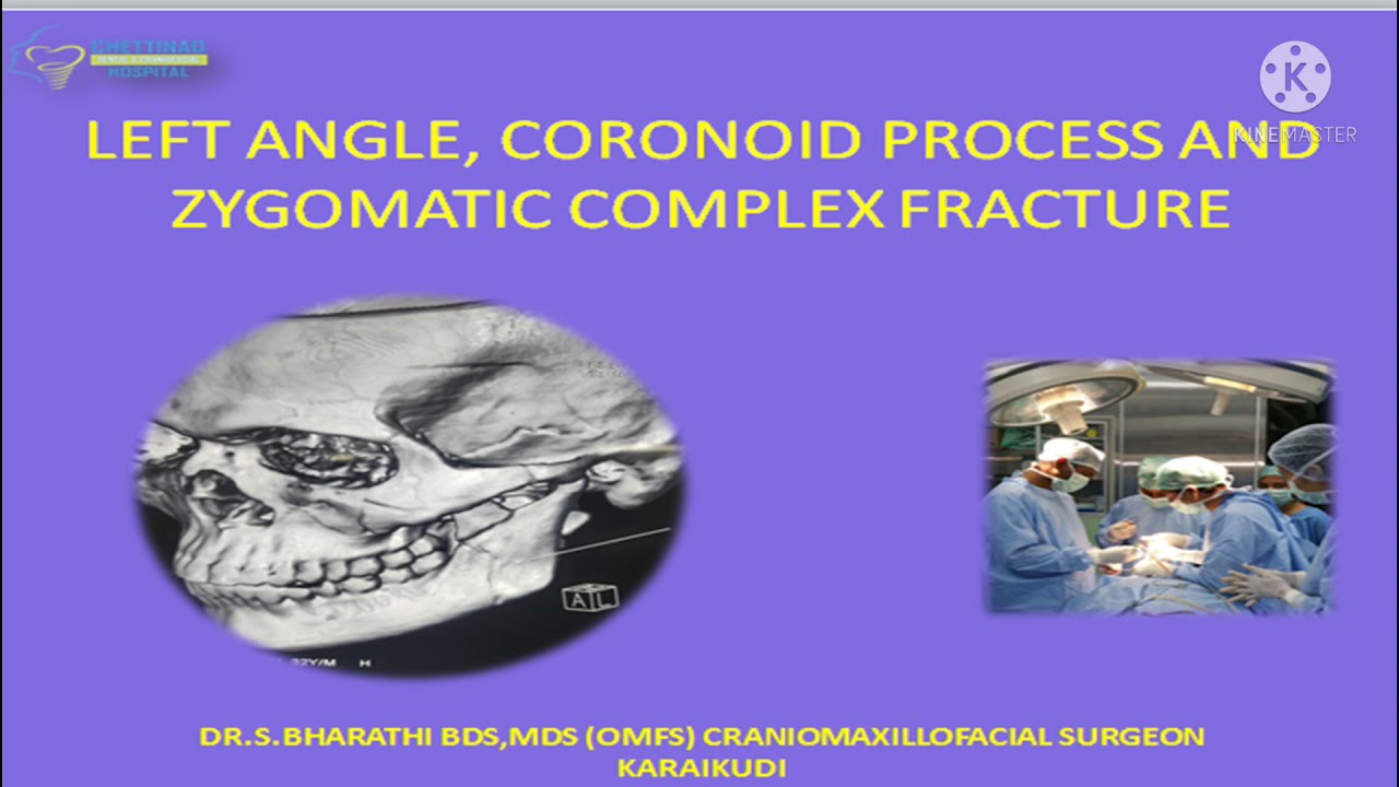 LEFT ZYGOMATIC COMPLEX WITH ANGLE AND CORONOID PROCESS OF MANDIBLE ...