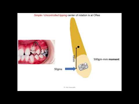 Basics of Biomechanics 2 (types of tooth movement and couple) - YouTube