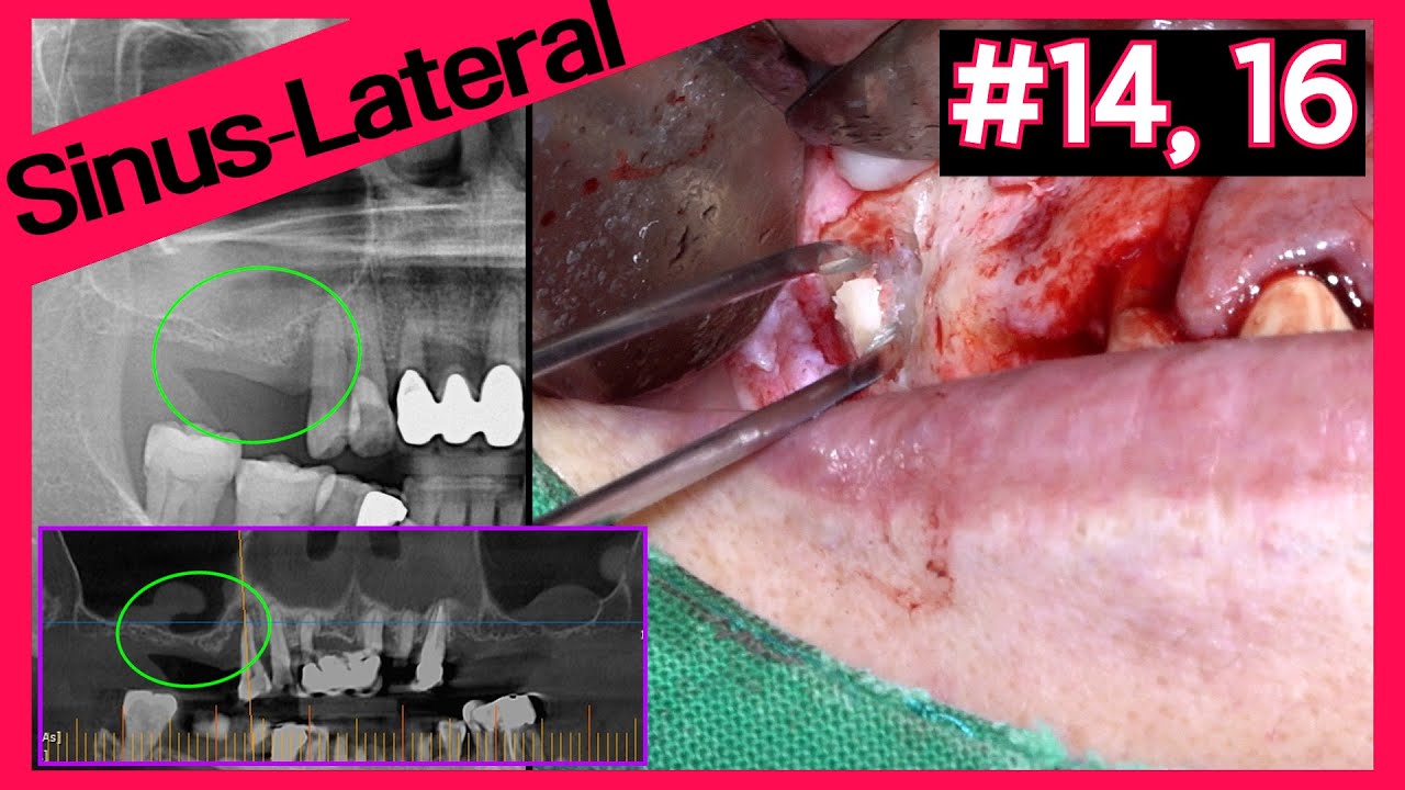 [Online Surgery] Immediate implantation & Sinus lateral augmentation ...
