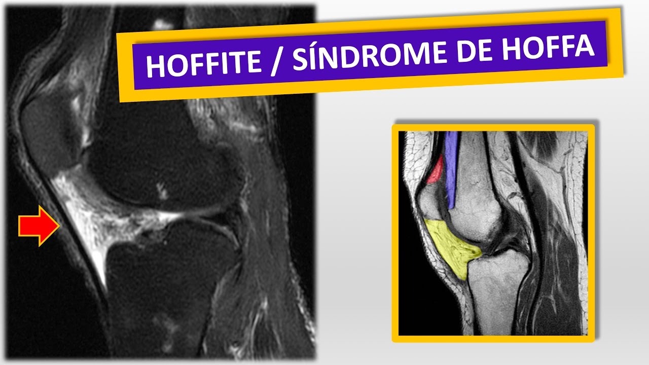 JOELHO - HOFFITE / SÍNDROME DE HOFFA - YouTube