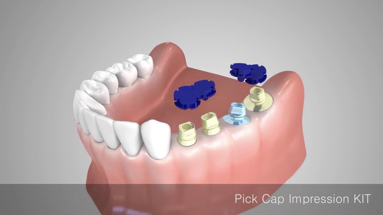 ピックキャップインプレッションキット (Pick Cap Impression Kit) - YouTube