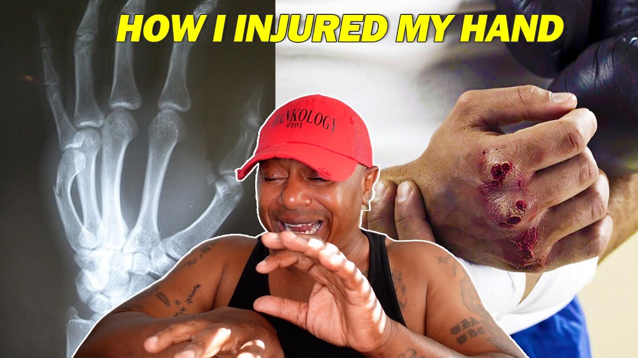 The Story Behind My Hand Injury! - YouTube