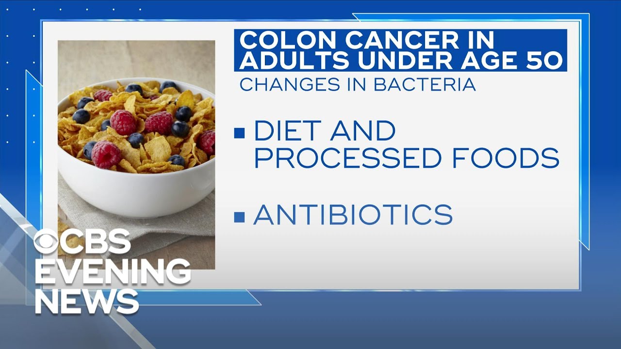 Study finds colon cancer rates rising for patients under 50 - YouTube
