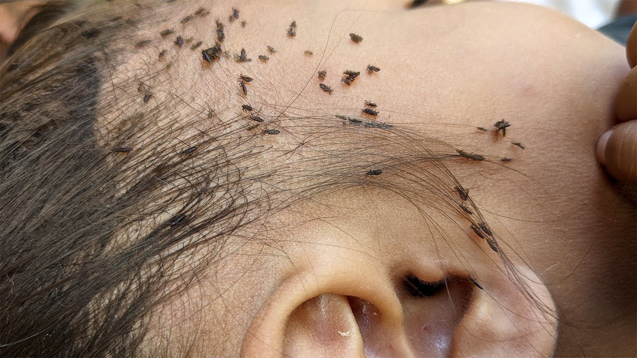 Remove So Many Big Lice From Blank Hair - YouTube