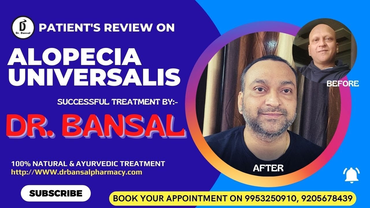 Exclusive REVIEW on ALOPECIA UNIVERSALIS TREATMENT by Dr. Bansal - YouTube