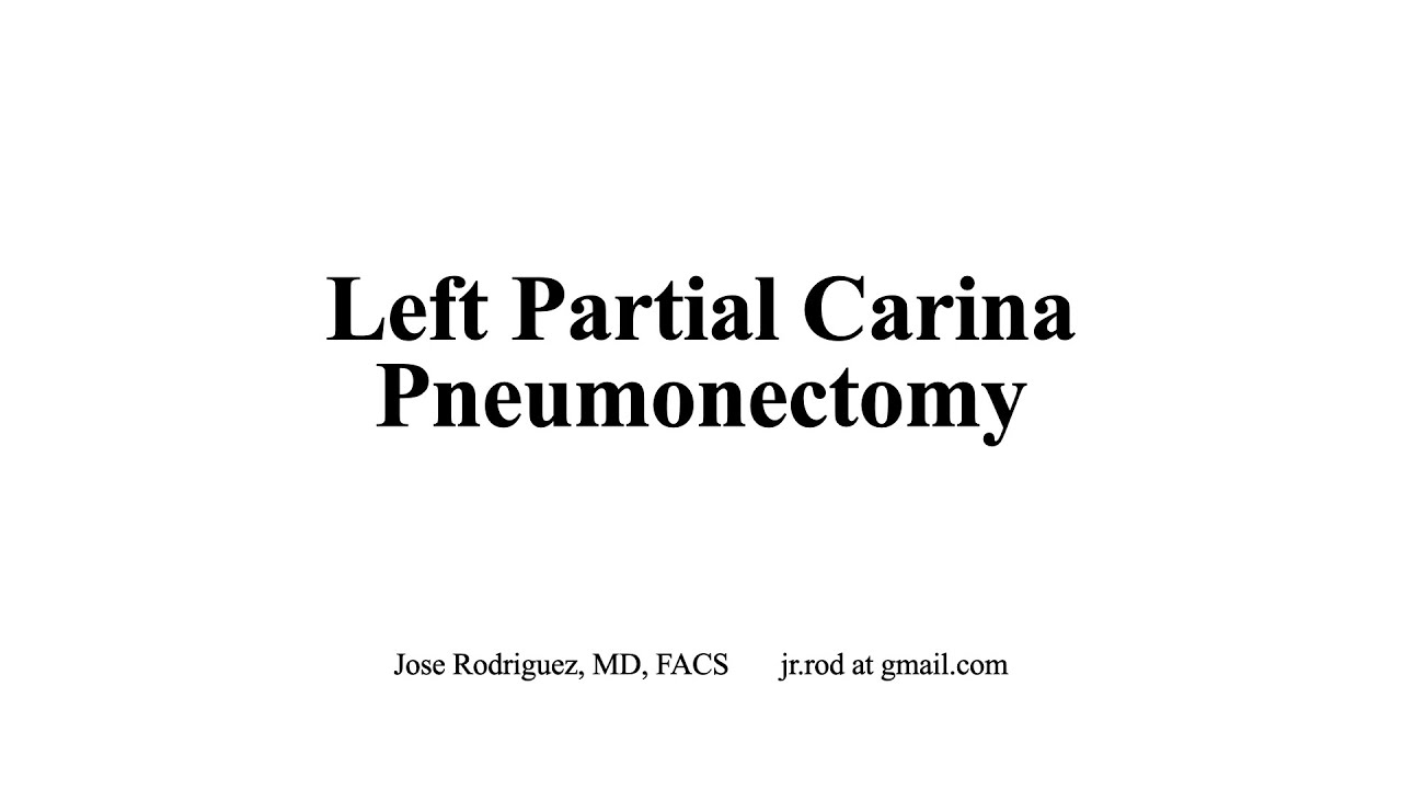 Left carina pneumonectomy HD 1080p - YouTube