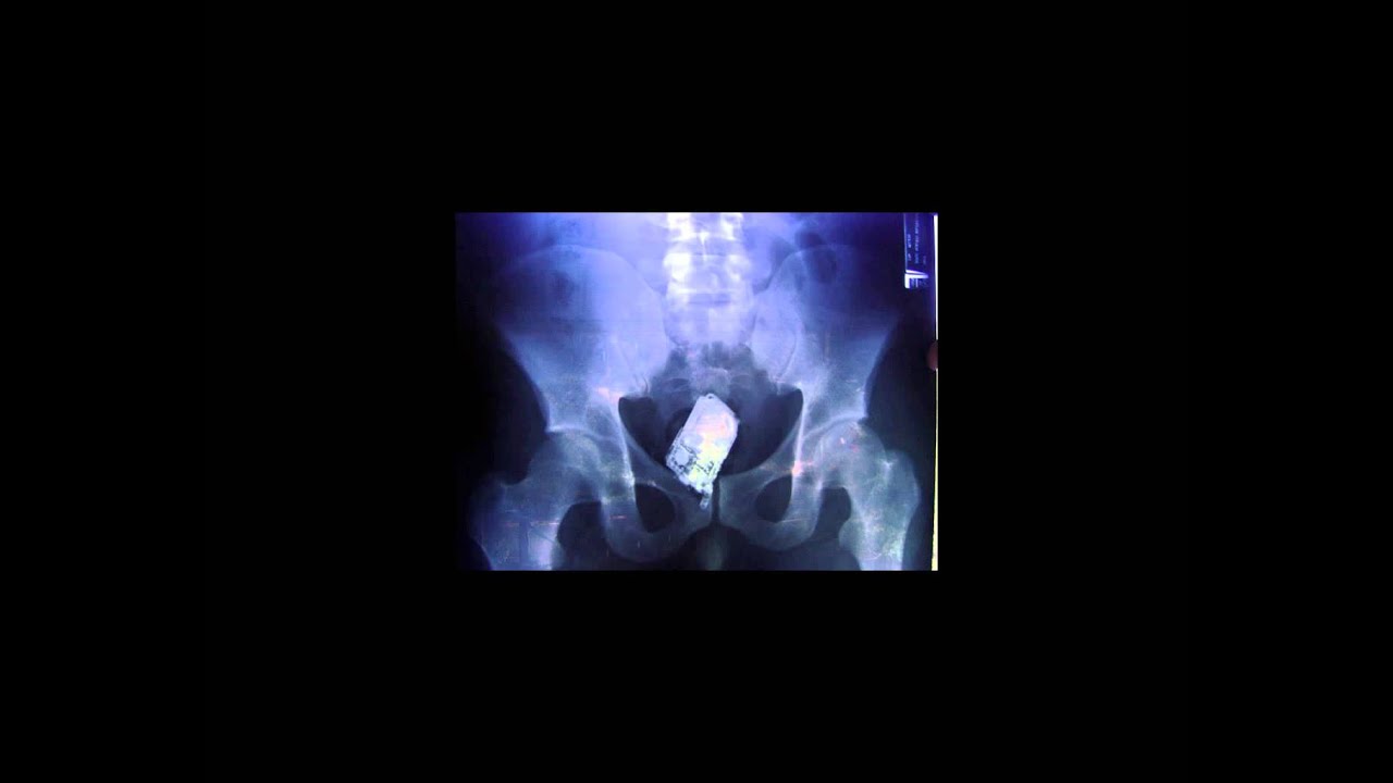 World Most Amazing X-Rays - Compilation - YouTube