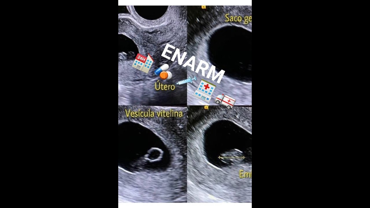 EMBARAZO ECTÓPICO (ENARM.2020) - ECTOPIC PREGNANCY - YouTube