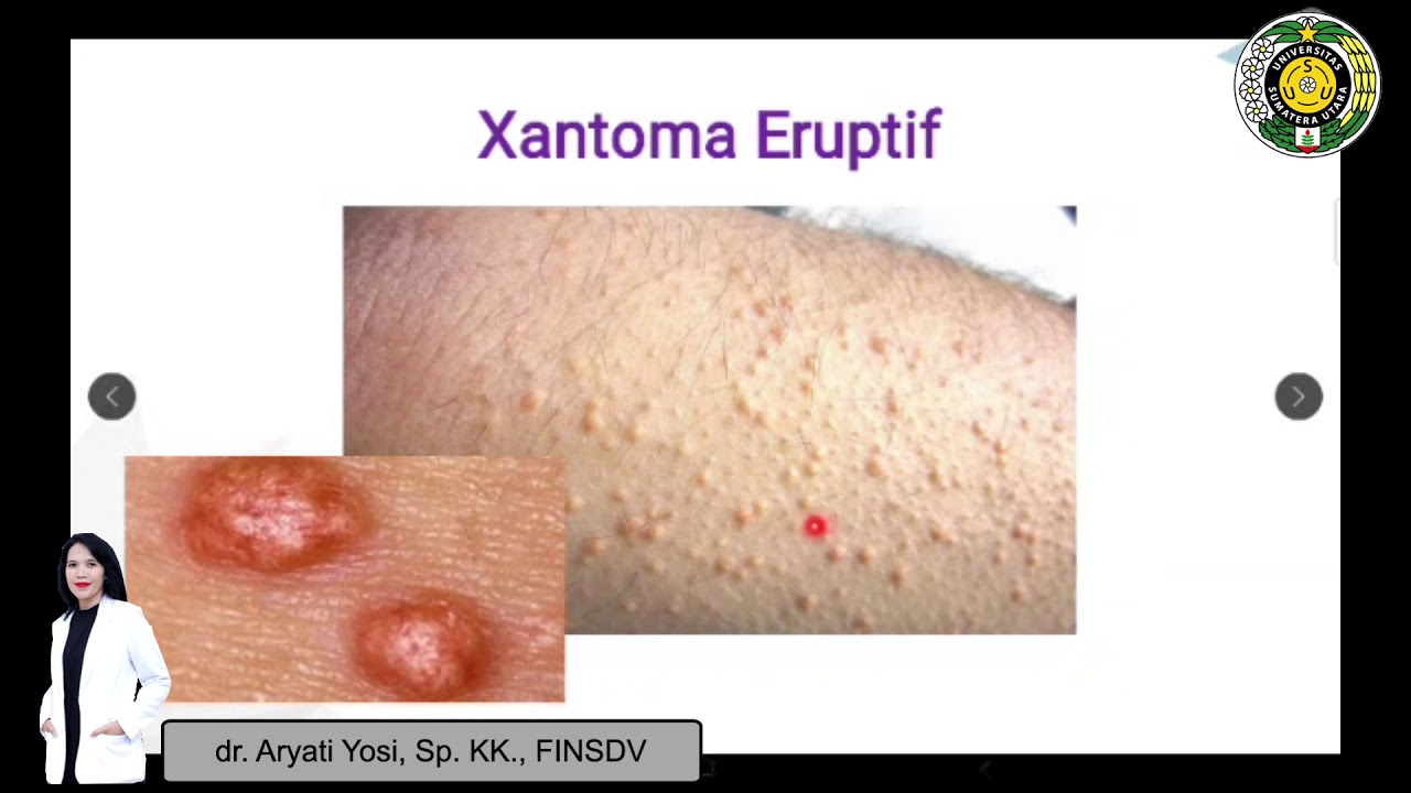 Kelainan Kulit pada Pasien DM - YouTube