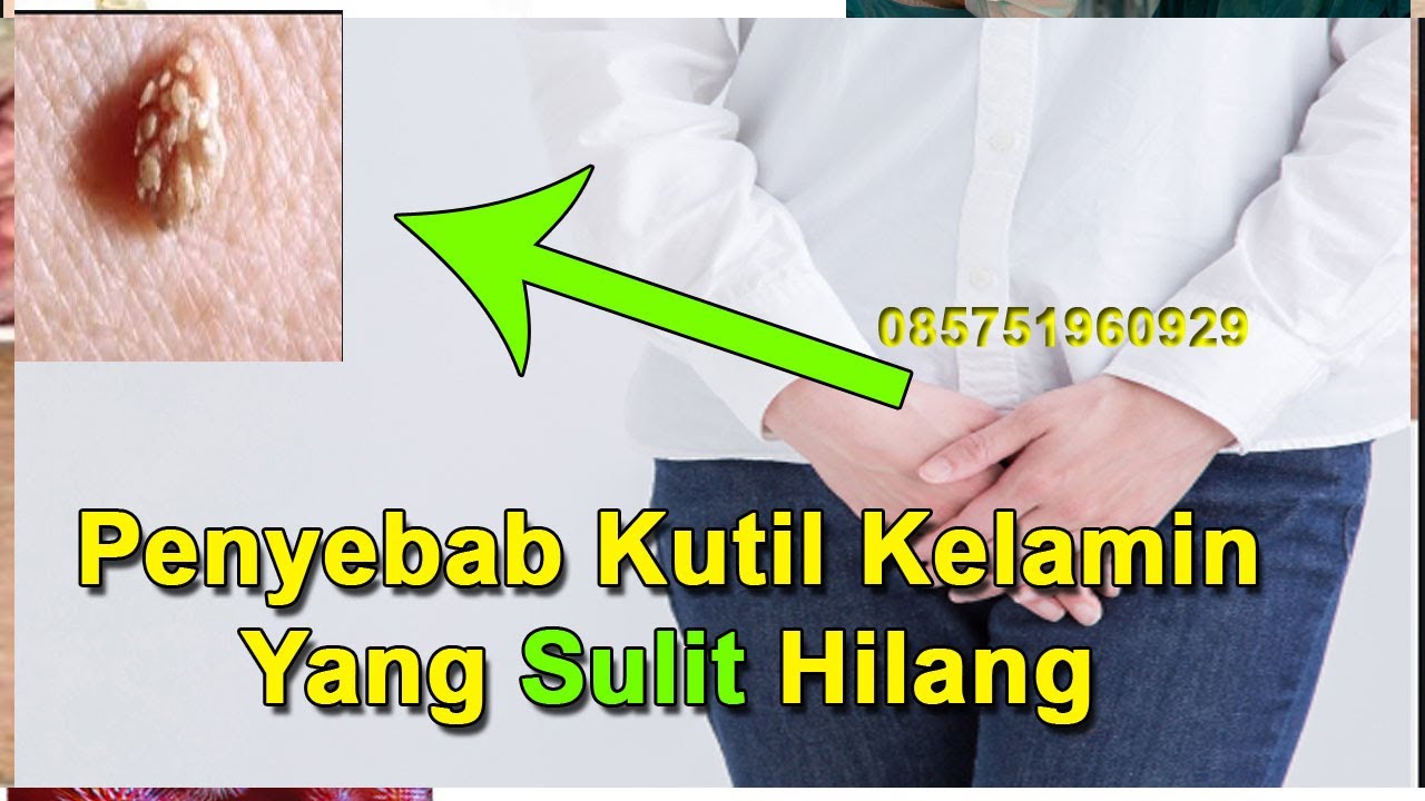Penyebab Kutil Yang Sulit Hilang - YouTube