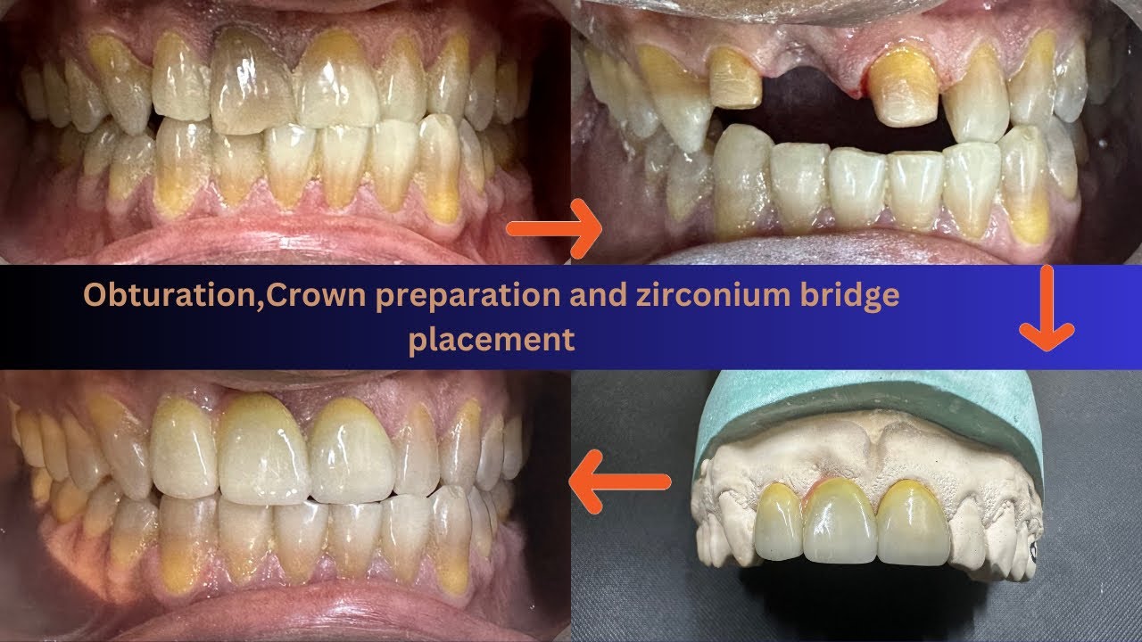 Zirconium bridge for front teeth /obturation, crown preparation and ...