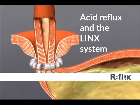 Reflux Disease and LINX Treatment - YouTube