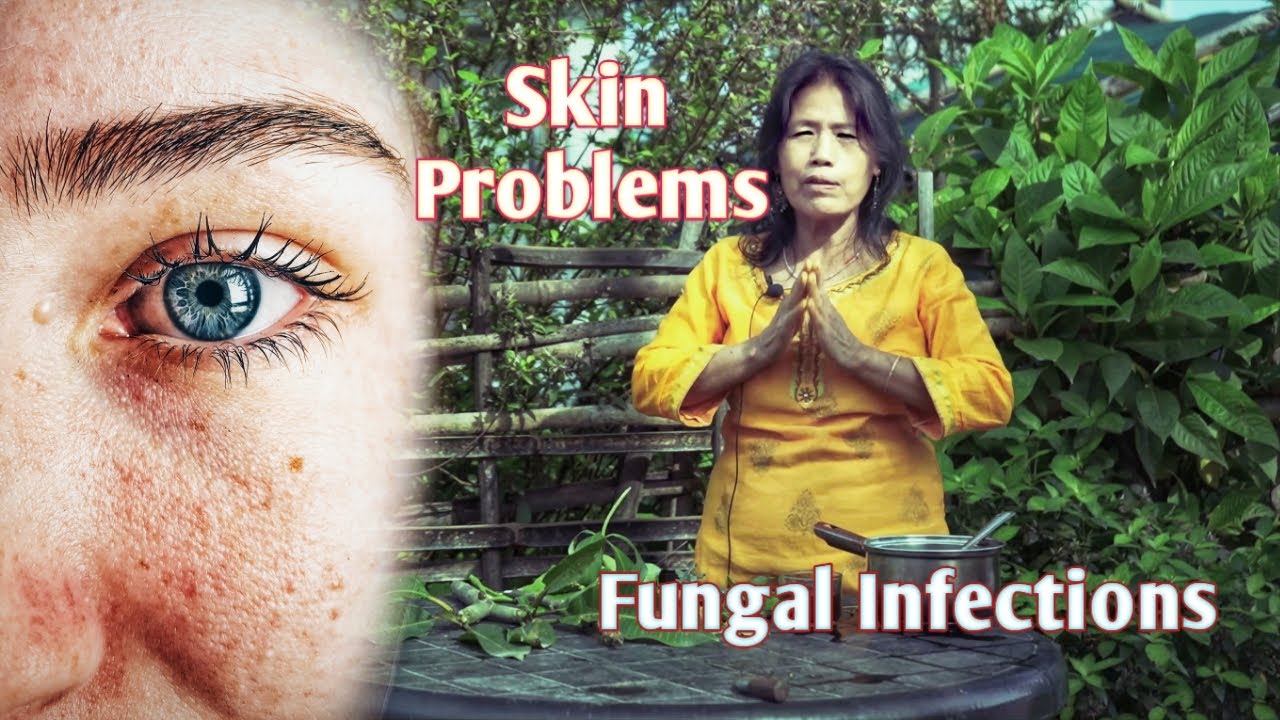 Skin Diseases|Fungal Infection Of Skin|Remedy At Home. Northeast india ...