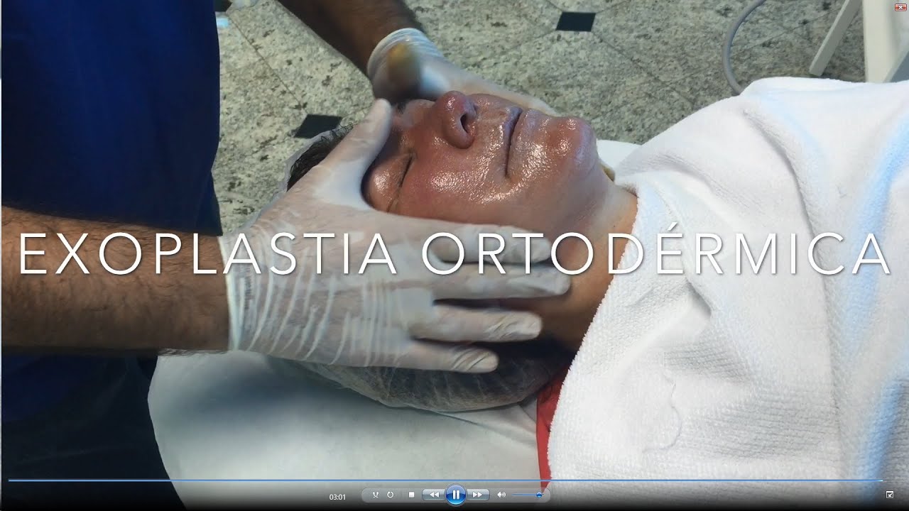 Exoplastia Ortodérmica (Peeling de Fenol Light) - Como é o procedimento ...