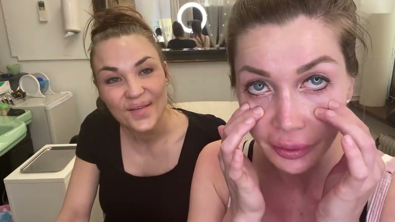 Pixee Fox remove Brightocular iris implants after 5 years - YouTube