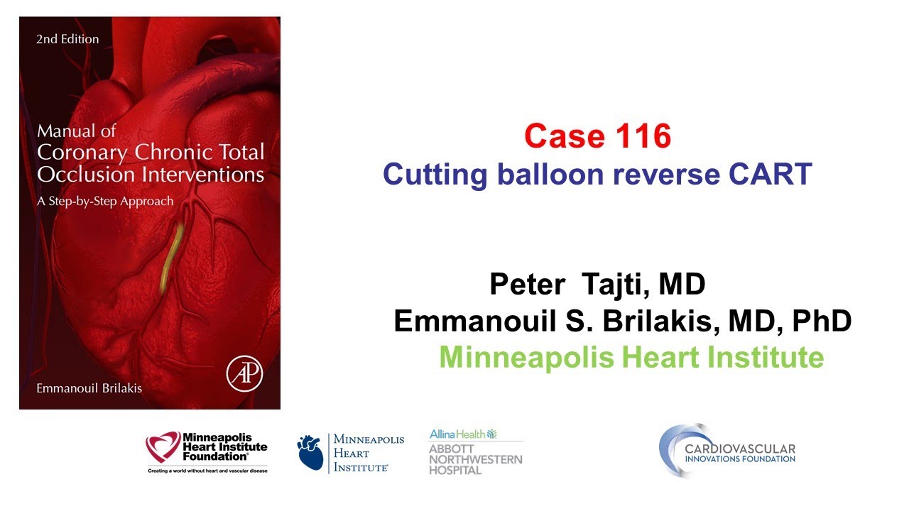 Case 116: Manual of CTO Interventions: Cutting-balloon assisted reverse ...