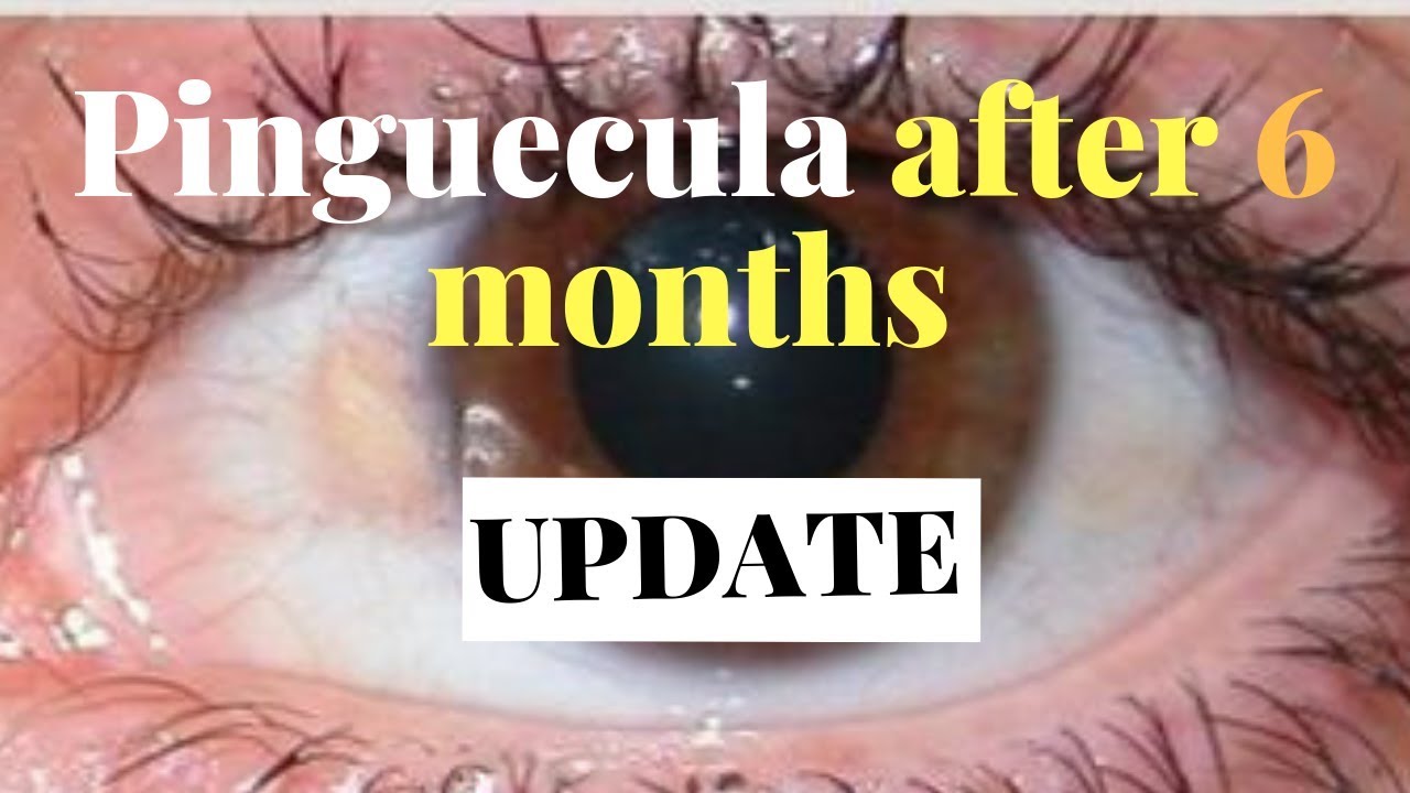 How I fight pinguecula yellow spot on eyes after 6 months update/NO ...