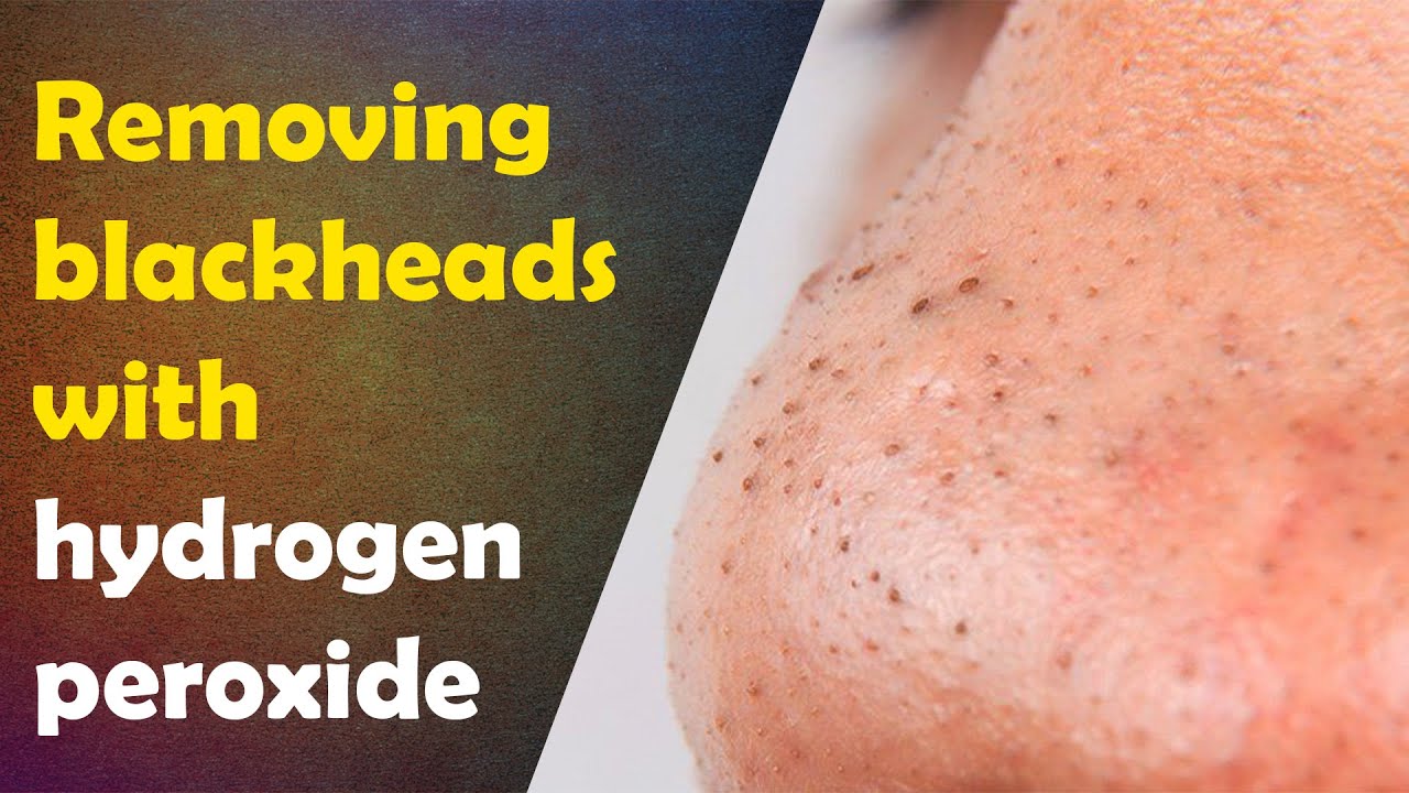 Skin Care Beauty : Hydrogen Peroxide Benefits To Remove Blackheads ...