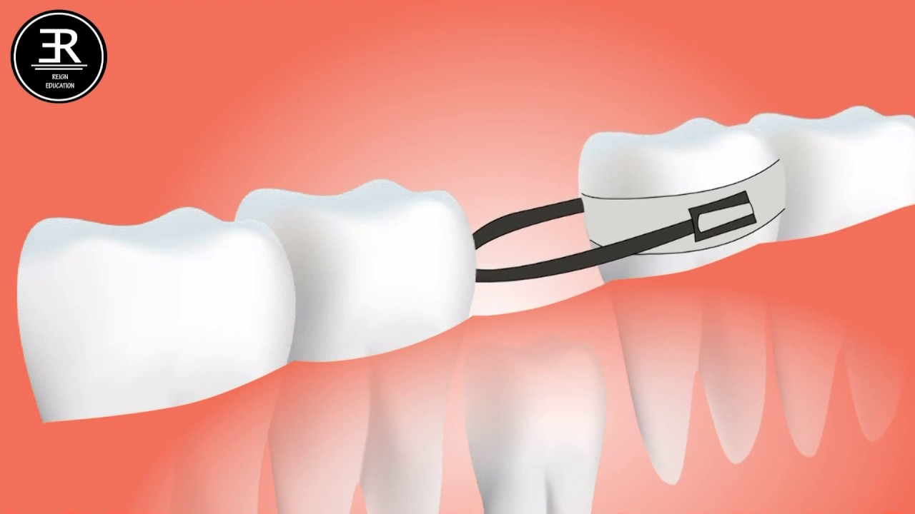 Making Tooth Gap with the help of Braces- #ReignEdu Animation Series ...