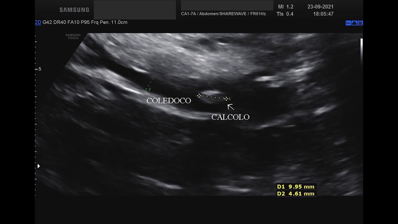 calcolo del tratto distale del coledoco - YouTube