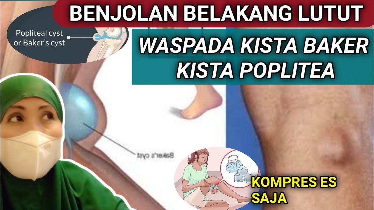 BENJOLAN DI BELAKANG LUTUT - PENGOBATAN KISTA BAKER ATAU KISTA POPLITEA ...