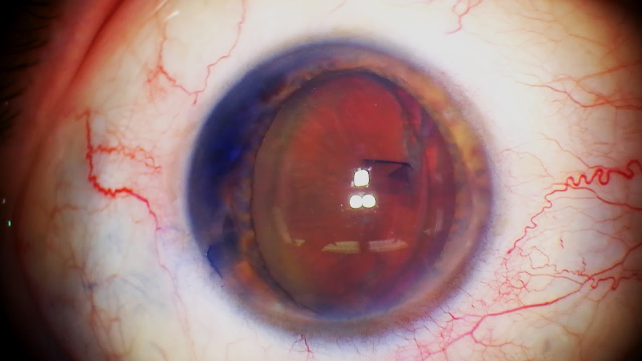 The Challenge: Very Dense Cataract, Vitrectomized Eye, Posterior ...