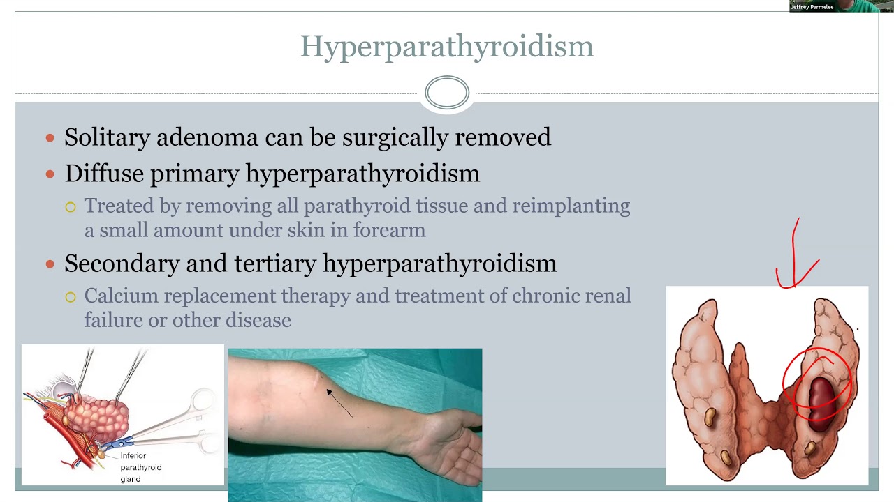Pathophysiology, Endocrine System Part 2 of 2. (Chapter 25) - YouTube
