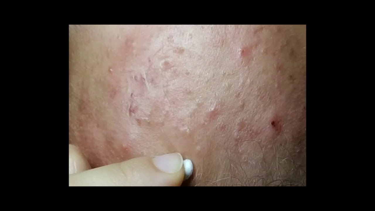 #3 BlackHead$ Blackhead removing, mitesser entfernung, mitesszer ...