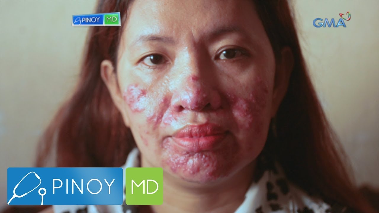 Pinoy MD: Sanhi ng adult acne sa mga babae, tinalakay sa ‘Pinoy MD ...